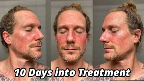 My Experience with Efudix Skin Cancer Cream - The Raw Advantage