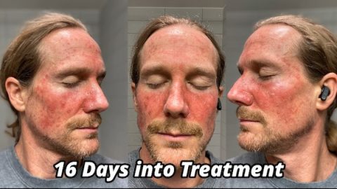 My Experience with Efudix Skin Cancer Cream - The Raw Advantage