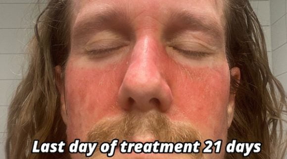 My Experience with Efudix Skin Cancer Cream - The Raw Advantage