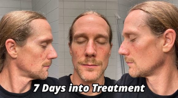 My Experience with Efudix Skin Cancer Cream - The Raw Advantage